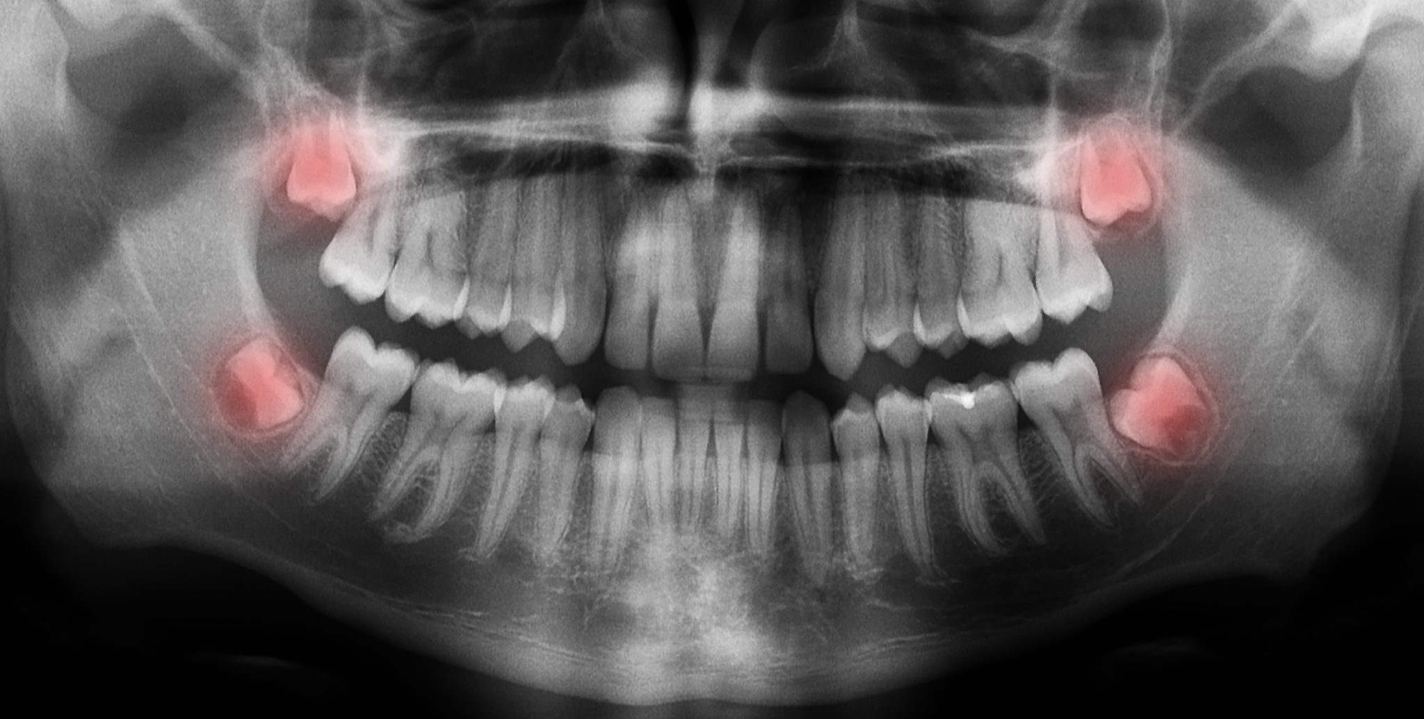 Chirurgie orale - Dr. François Maschino - Chirurgien Dentiste